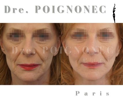 Mini lift visage avant après Paris - Eiffel | Dr. Sylvie POIGNONEC