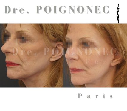 Mini lift visage avant après Paris - Eiffel | Dr. Sylvie POIGNONEC