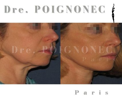 Mini lift visage avant après Paris - Eiffel | Dr. Sylvie POIGNONEC