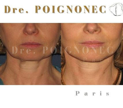 Mini lift visage avant après Paris - Eiffel | Dr. Sylvie POIGNONEC