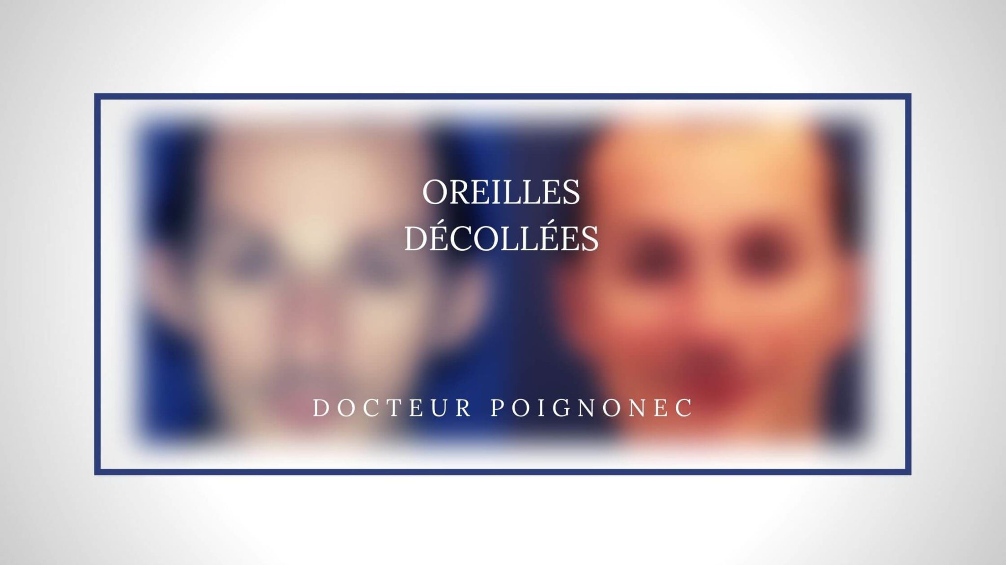 Oreilles décollées Otoplastie Paris - Eiffel | Dr. Sylvie POIGNONEC