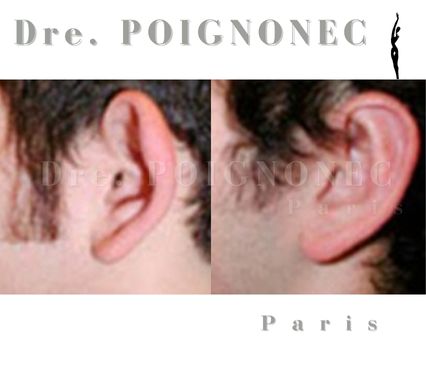 Oreilles décollées Otoplastie Paris - Eiffel | Dr. Sylvie POIGNONEC